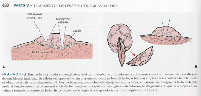 Muito bom esse café !: Biopsia Incisional e Excisional (Estomatologia)