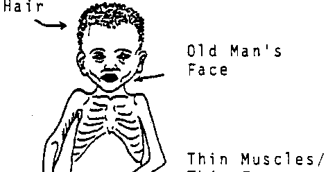 Marasmus ~ Medical Articles