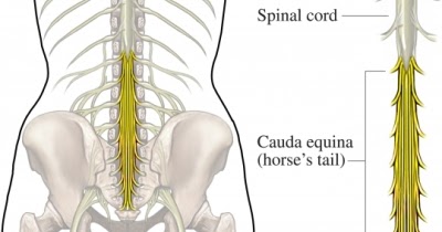Sindrome da Cauda Equina