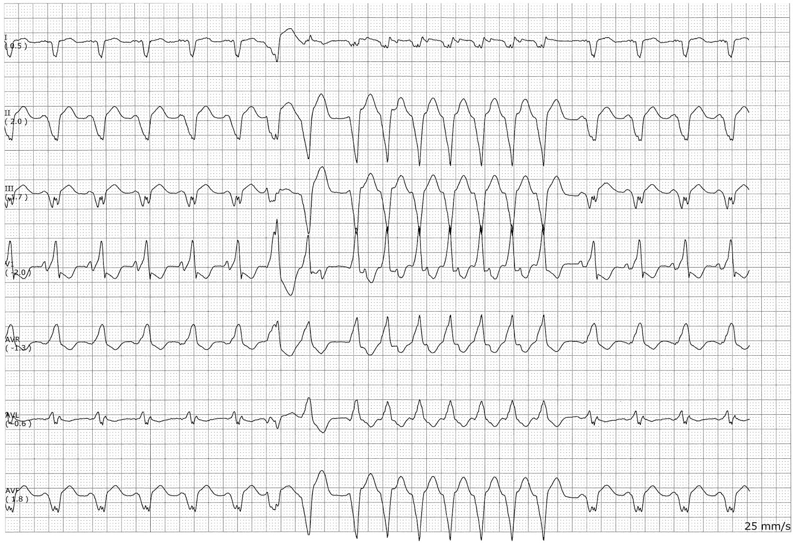 Sinus Rhythm With A Wide QRS Complex With A Run Of Ventricular Tachyardia sinus-rhythm-with-a-wide-qrs-complex-with-a-run-of-ventricular-tachyardia