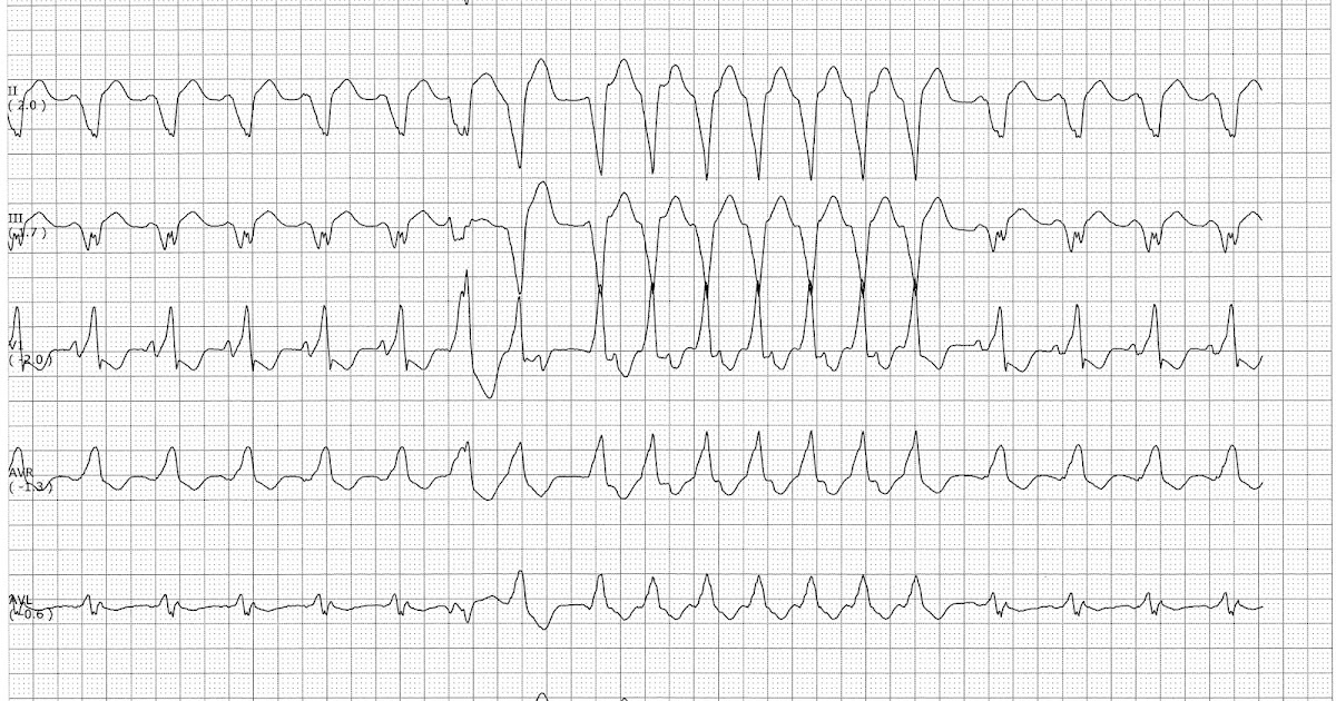 Sinus Rhythm with a Wide QRS Complex with a Run of Ventricular Tachyardia