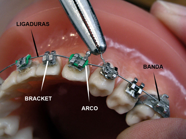 Clinica Dentis Implant: ¿Cómo limpiar los brackets?