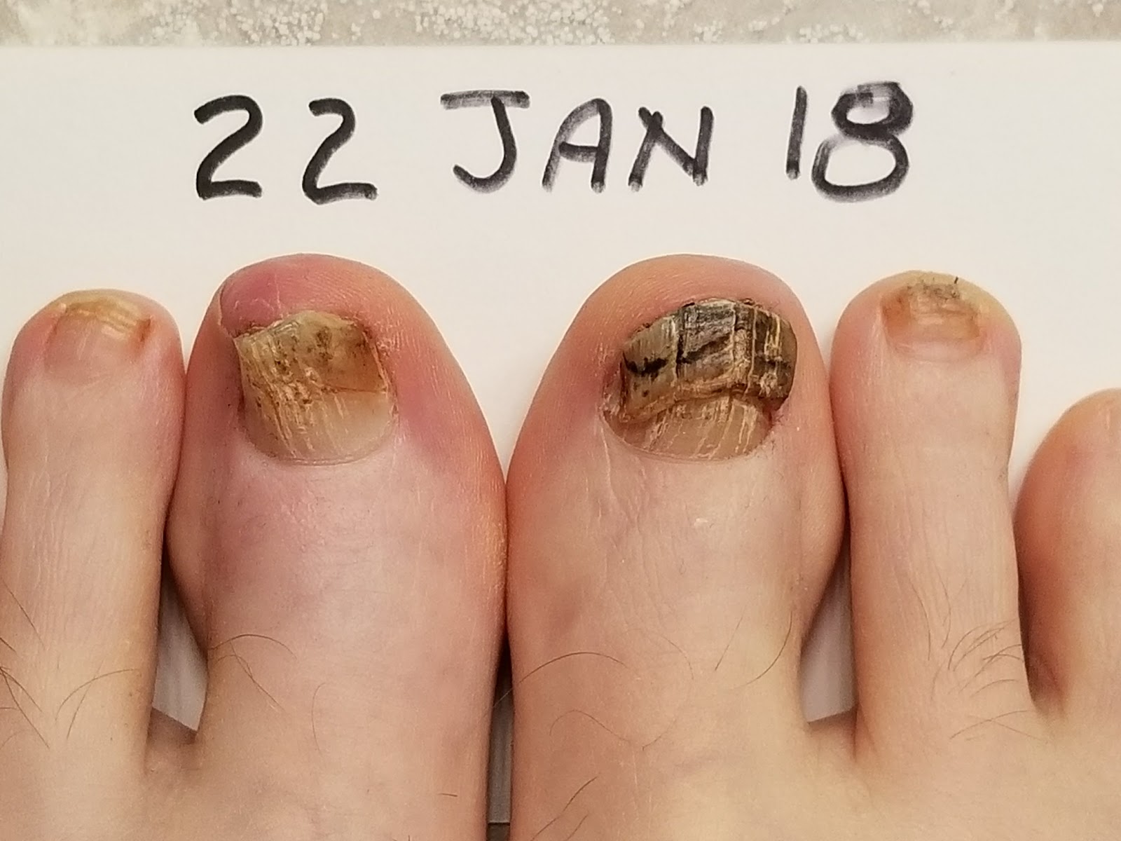 Run with Perseverance: A Tale of Two Toenails; How to Fix Runner's Toenails