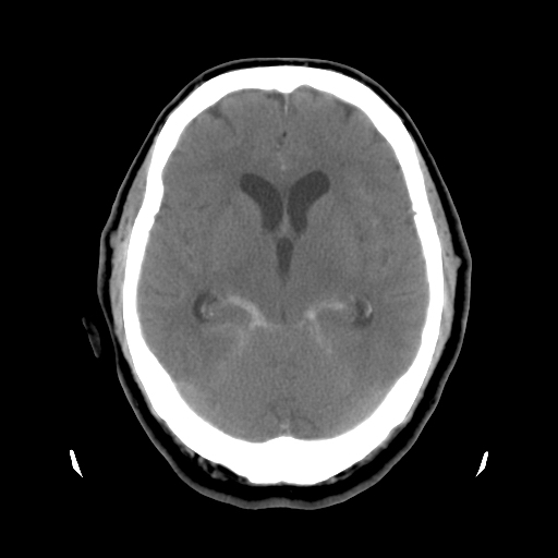 X-RAYview: Hemorragia SUBARACNOIDEA