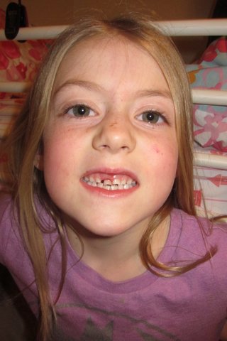 The Hansens: Allie looses her 1st top tooth