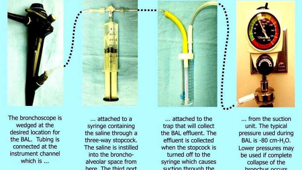 Bronchoalveolar lavage