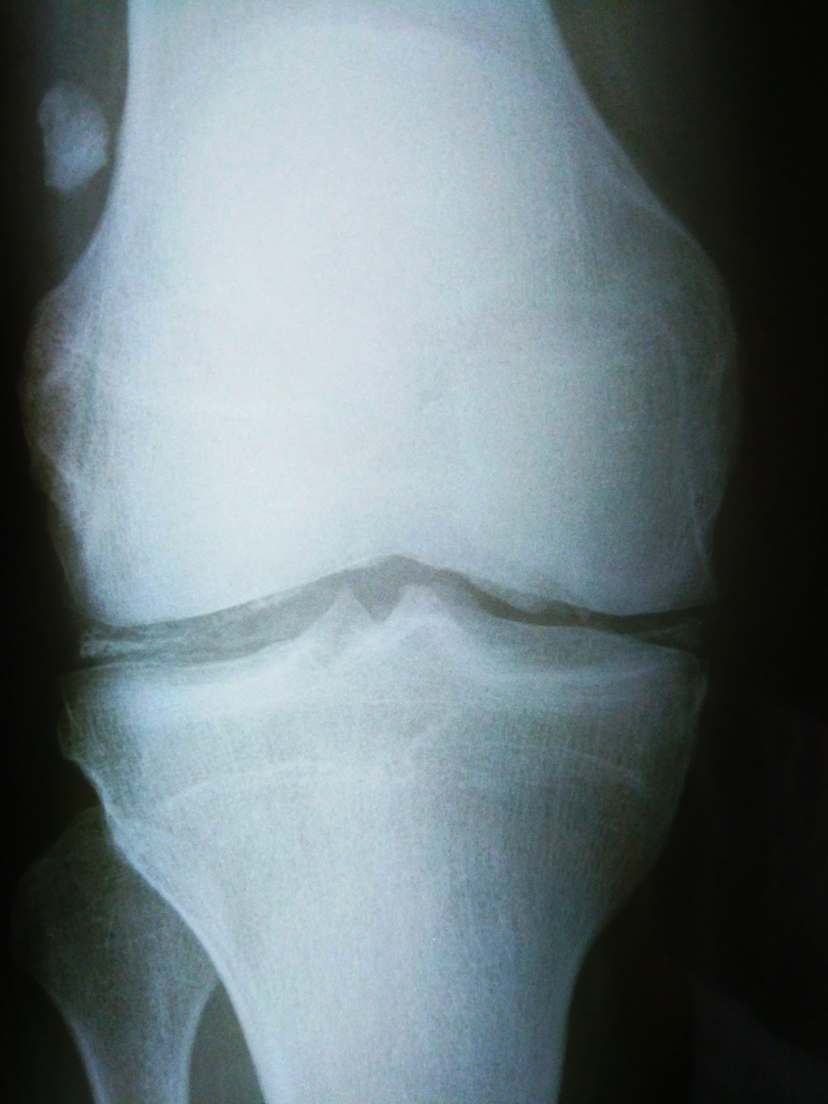 fotos personales y curiosas: RX CALCIFICACION PARTES BLANDAS EN LA RODILLA