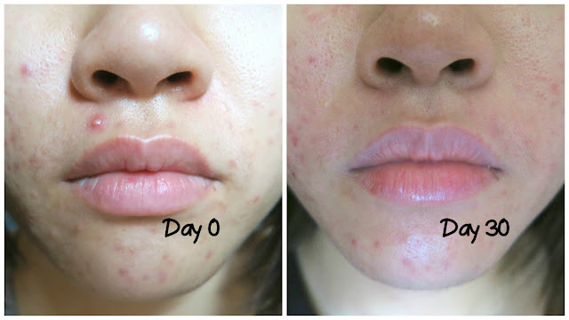 Beauty and Fashion Habitué: Accutane/Roaccutane Update: One-Month Mark!