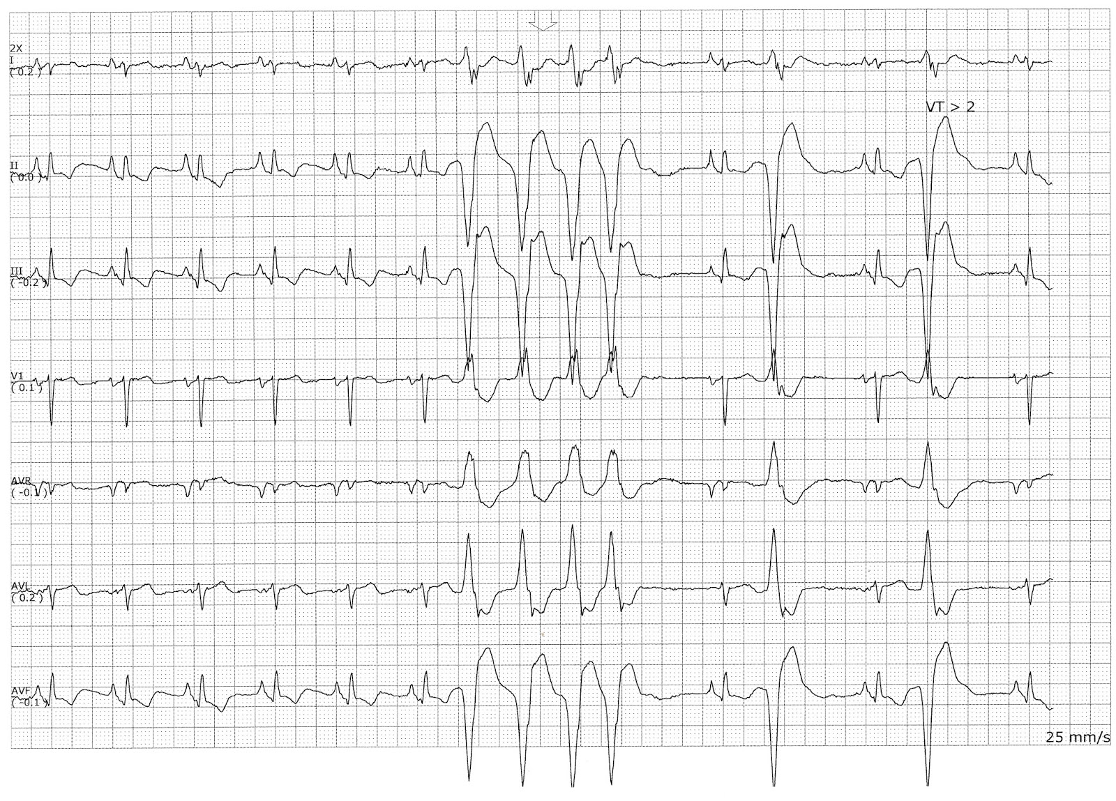 Sinus rhythm with 4 beat run of VT changing to bigeminal PVCs