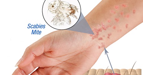 About Health: Scabies
