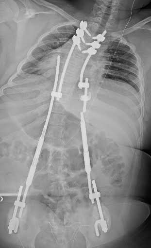 MAGEC (Part 2) | Growing Spine Blog | Washington University in St. Louis