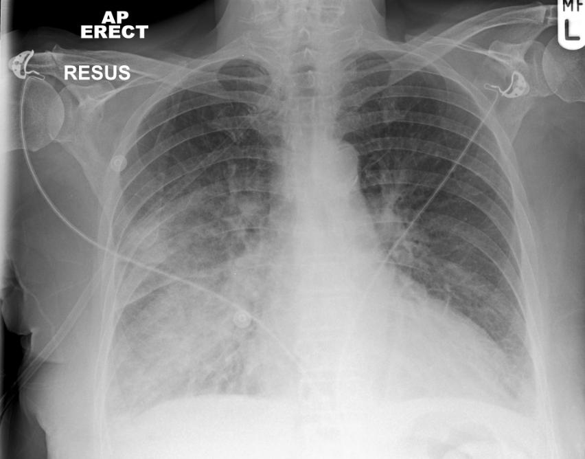What Is Pulmonary Edema? - Teroes