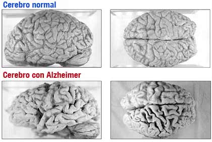 Enfermedad de Alzheimer: ¿Cuáles son las formas de diagnosticar la ...