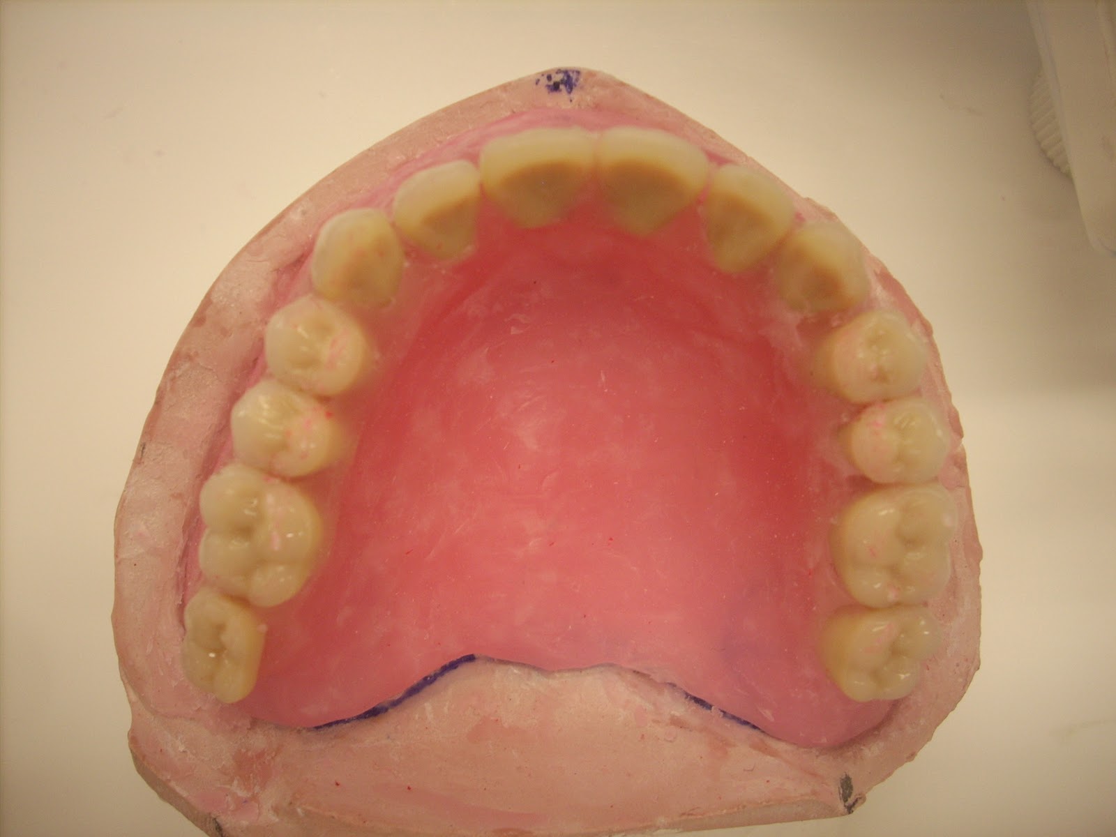 Dentistry: Complete Denture