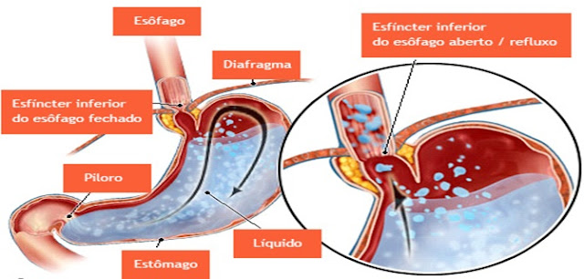 O refluxo gastroesofágico é uma doença que atinge um grande número de ...