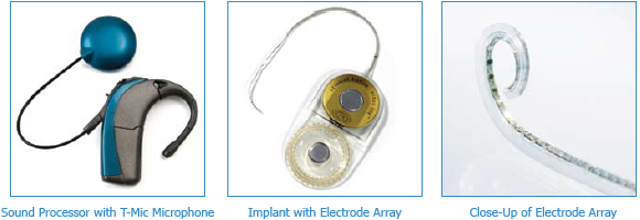 Aura: Como funciona o implante coclear