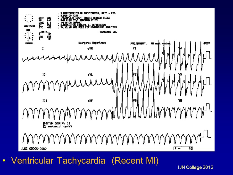 CVT Mohd Farid: Electrocardiogram Arrhythmia Part II-Credit Dr ...