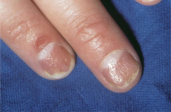 Nail pitting: Nail pitting causes