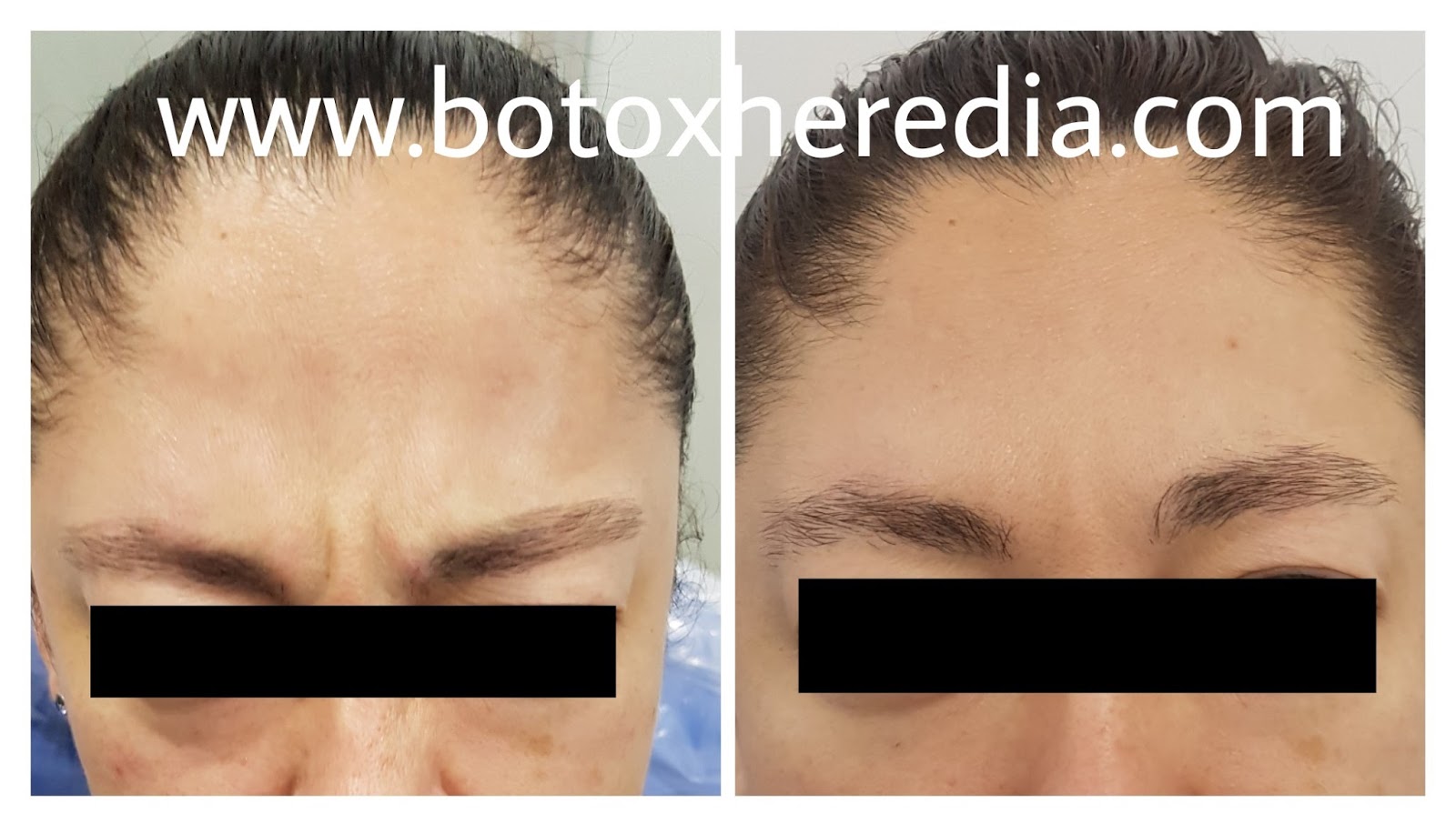 Botox, Acido Hialurónico, Bichectomia, Invisible Touch Hilos Pdo