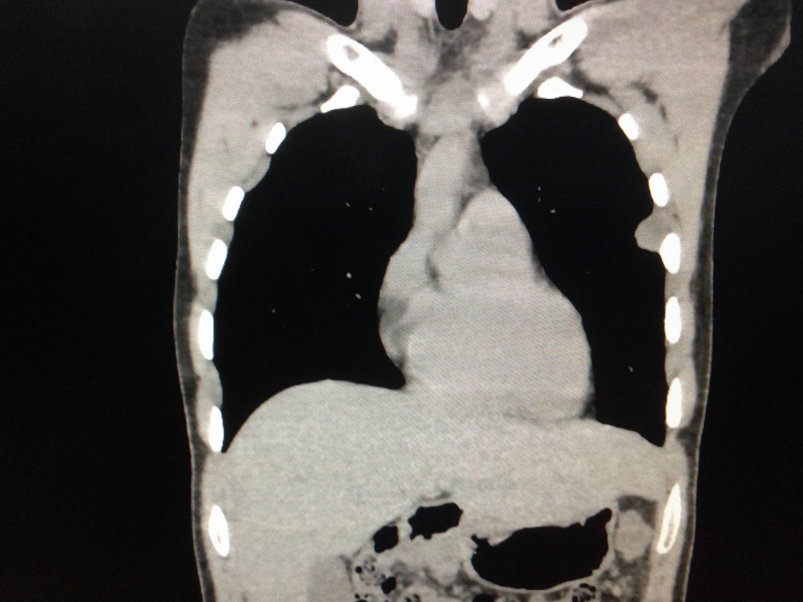 VIETNAMESE MEDIC ULTRASOUND: CASE 426: MULTIPLE TUBERCULOSIS ABSCESSES ...