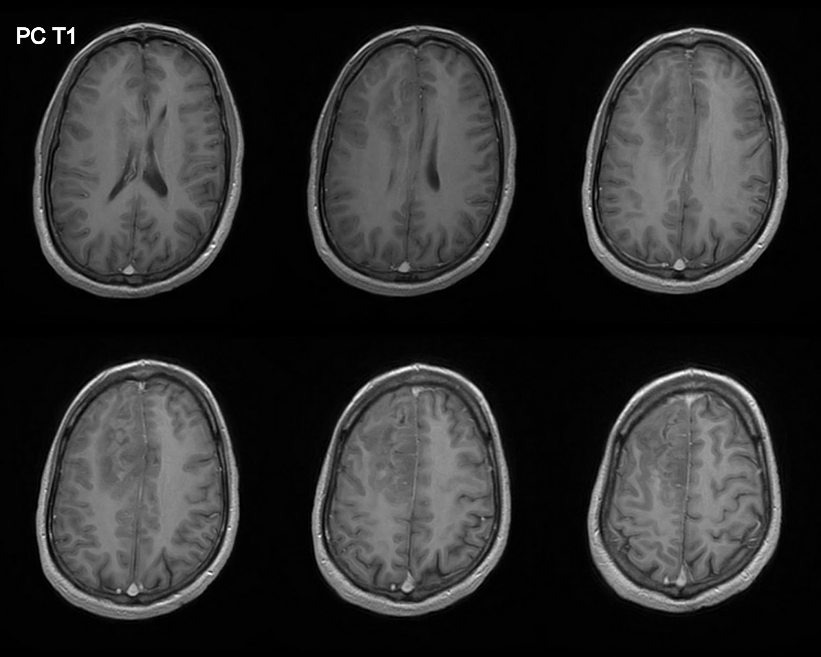 Dr Balaji Anvekar FRCR: Frontal lobe SOL on MRI