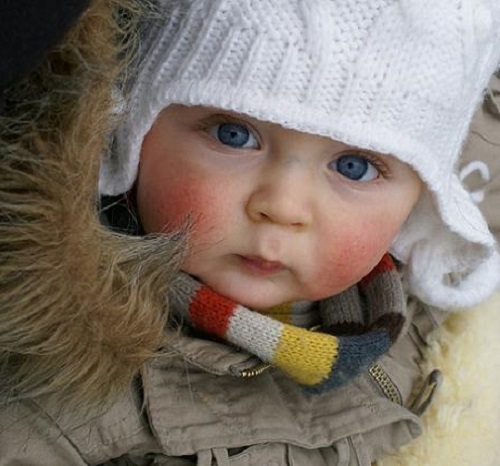 Tratamiento para la Rosacea en Niños | Rosacea Ocular Infantil!