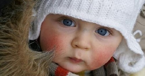 Tratamiento para la Rosacea en Niños | Rosacea Ocular Infantil!