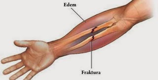 LAPORAN PENDAHULUAN FRAKTUR ANTEBRACHII