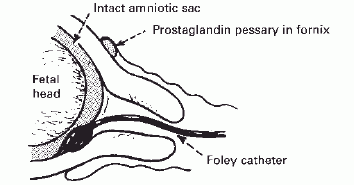 Ob/Gyn Updated : Misoprostol in combination with transcervical Foley ...