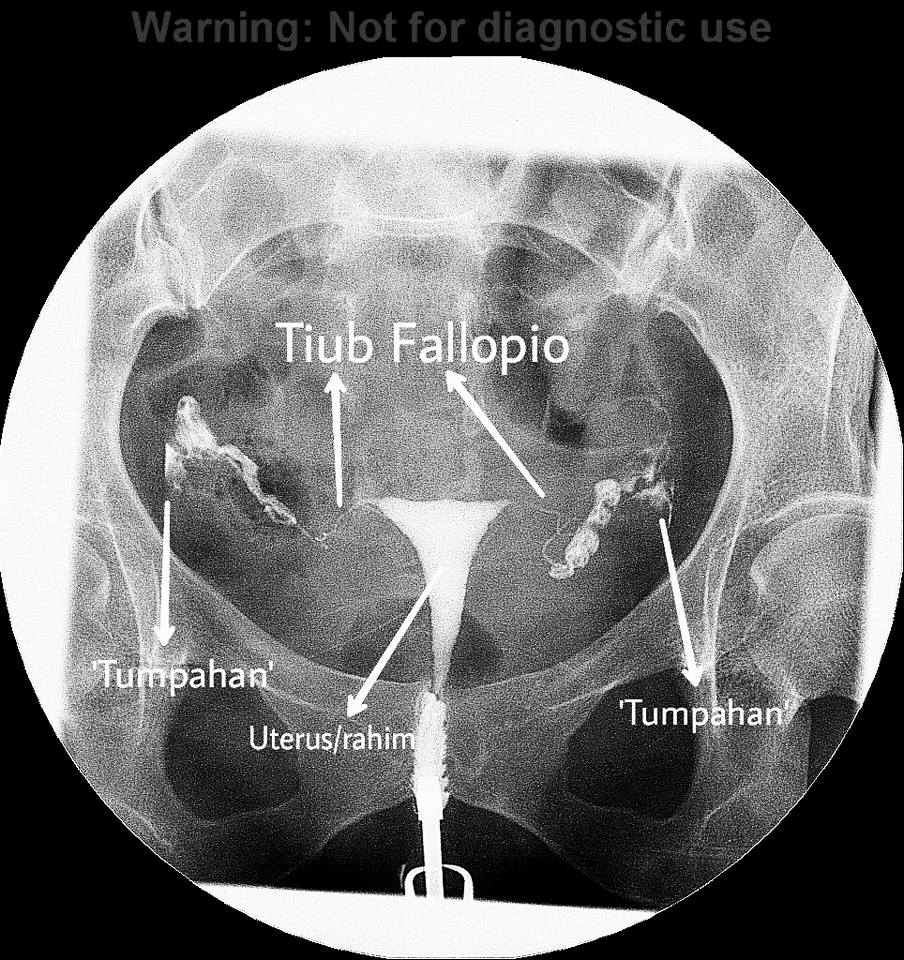 HSG - TIUB SAYA TERSUMBAT KE DOKTOR?