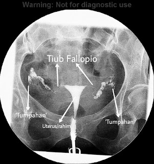HSG - TIUB SAYA TERSUMBAT KE DOKTOR?