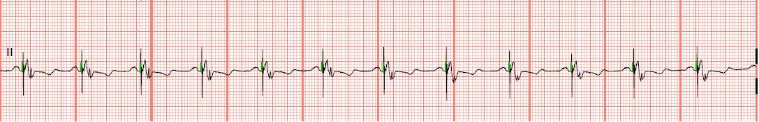 EKG Rhythm Strip Quiz 88