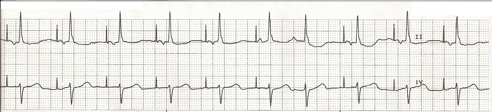 EKG Rhythm Strip Quiz 47