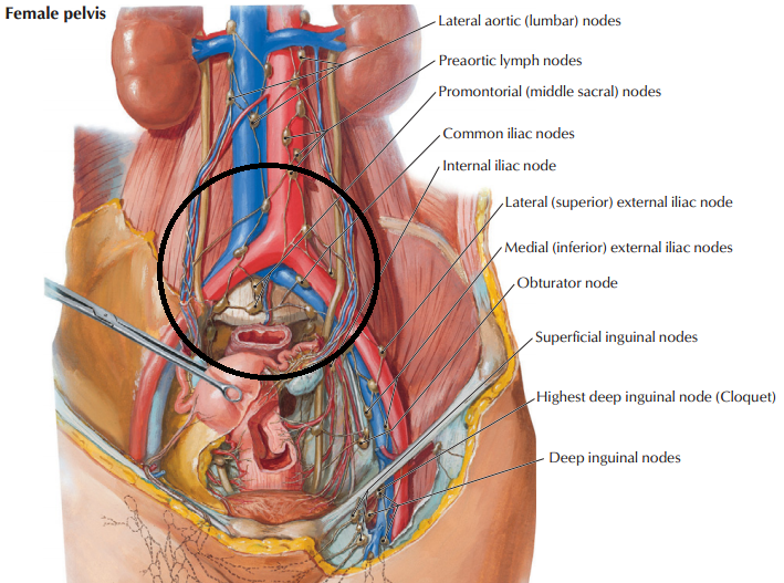 May Thurner Syndrome ~ Medicine Hack