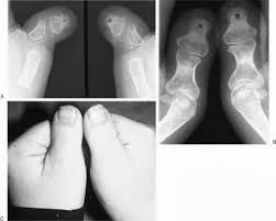 Medical Treatment Pictures-for Better Understanding: Rubinstein-Taybi ...