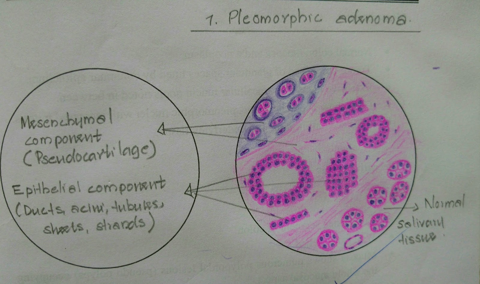 Histopathology Drawings: Pleomorphic adenoma