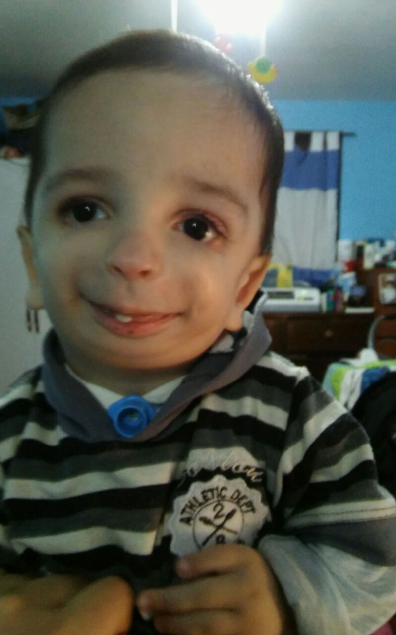 Beizos Galicia: Disostosis acrofacial de Nager