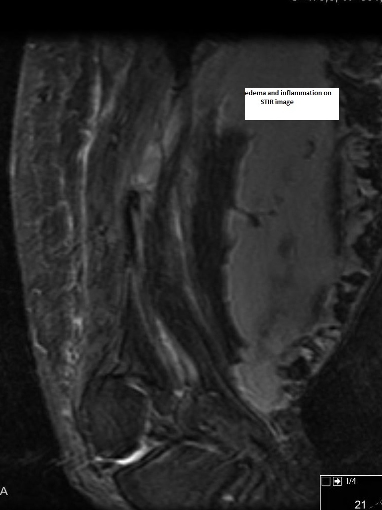Diabetic myonecrosis-MRI - Sumer's Radiology Blog