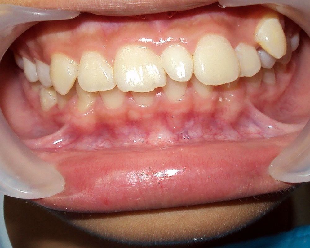 CASO CLÍNICO : Dientes supernumerarios. Reporte de un caso clínico