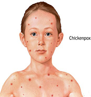 Useful Information: Home remedies for Chicken Pox