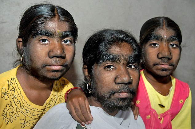 Wolfman family in India seeks help for their rare genetic affliction ...