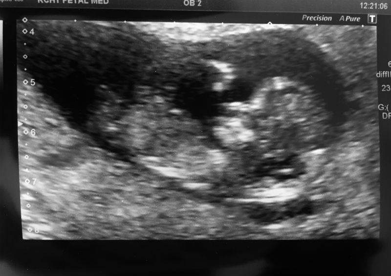 Lucy Skerritt Loves: BABY: The 12 Week Scan