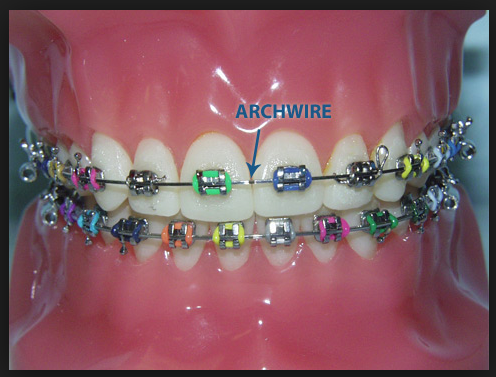 Robison Orthodontics Mesa Arizona : Dental Braces and More Pokey Wires ...