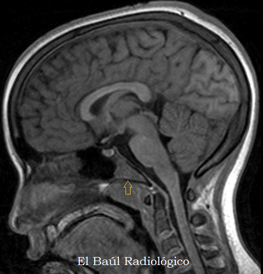 El Baúl Radiológico: SINCONDROSIS ESFENOBASILAR. (Sphenobasilar ...