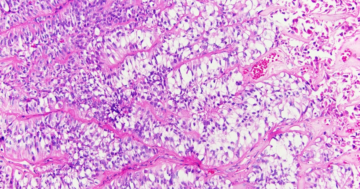 neuropathology blog: Astroblastoma