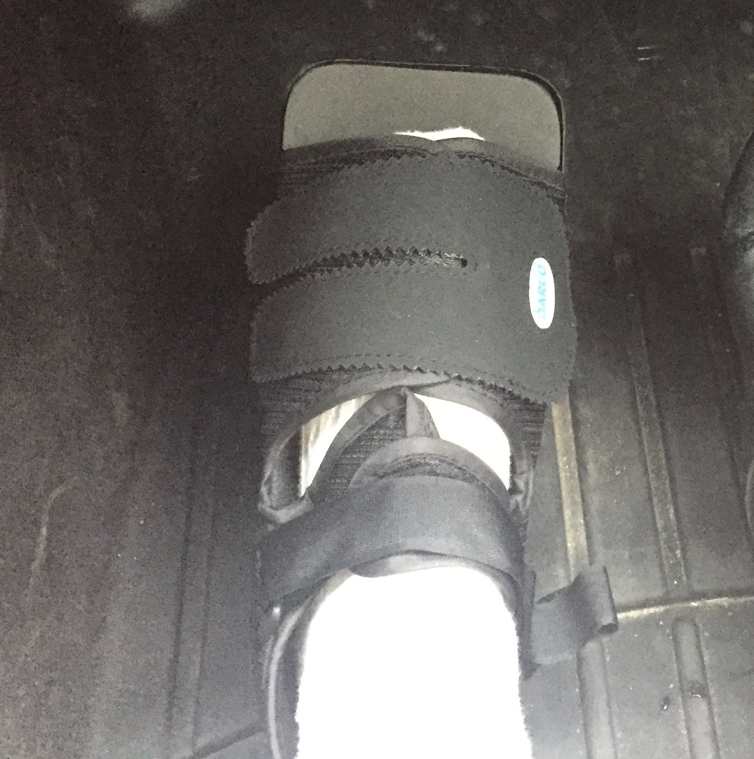 Before, During, & After Bunion Surgery...: #9 ~ Week Six Checkup and ...