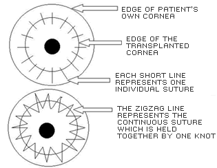 Through A Looking Glass: Corneal Stitches
