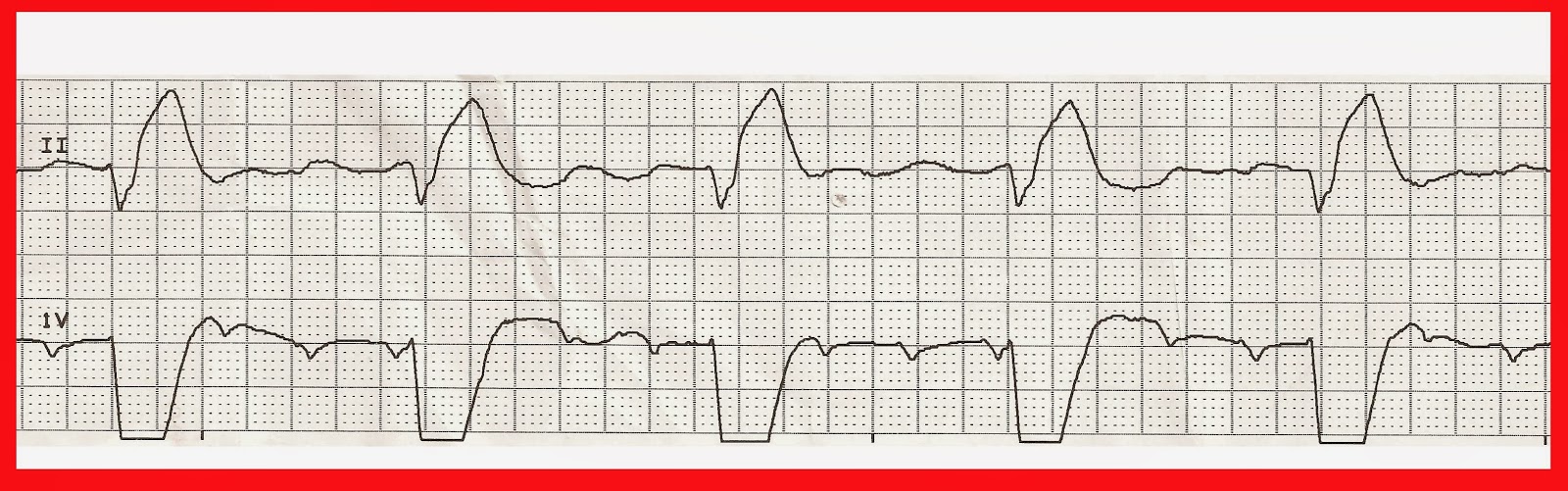 EKG Rhythm Strip Quiz 186