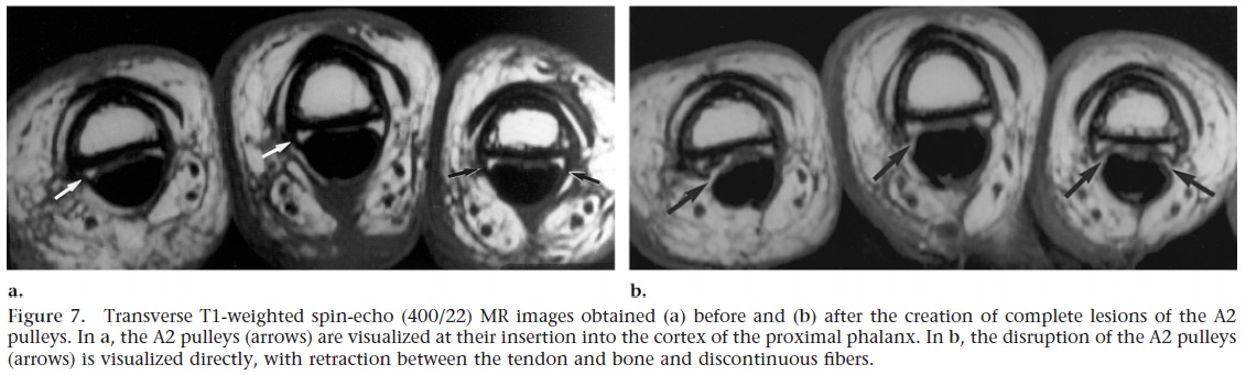 Tom's Physiotherapy Blog: Pulley Injuries: updated