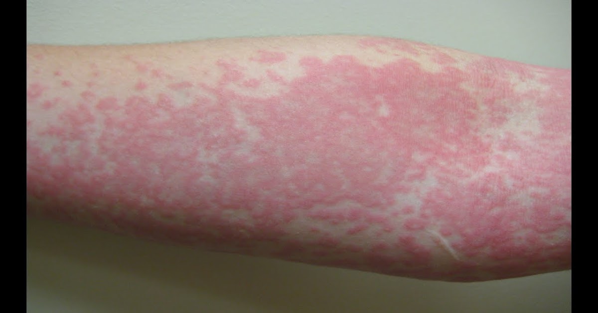 Dunia Unik: Penyakit kulit Kaligata ( biduran )